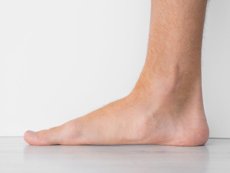 Artículo sobre Tratamiento Integral del Pie Plano ofrecido por Dr ...